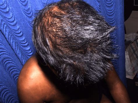 What Is Effective Scalp Psoriasis Treatment For Pregnant Women ResearchGate