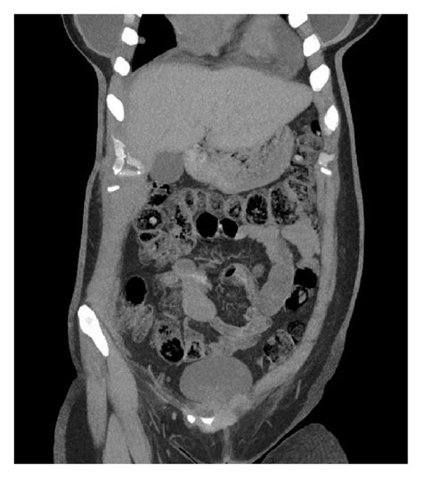 Abdominal Ct Scan With Evidence Of Small Bowel Intussusception Download Scientific Diagram