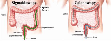 Colonoscopy Vs Sigmoidoscopy