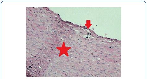 Intima Arrow And Media Star Layers On The Normal Aorta Wall
