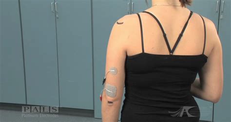 E Stim Electrode Placement