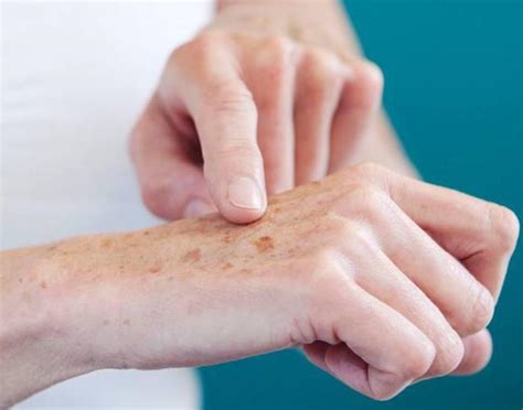 Как легко убрать возрастные пигментные пятна на руках На пенсии