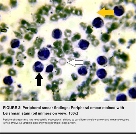 Figure 1 From The Leukemoid Reaction In Severe Alcoholic Hepatitis A Case Report Semantic Scholar