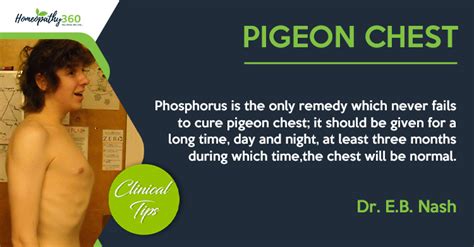 Pigeon Chest Clinical Tips By Dr Eb Nash