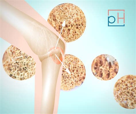 Calcitonin Function Uses And Side Effects Primehealth Denver