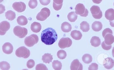 Chediak Higashi Syndrome Lymphocyte