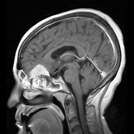 Planum Sphenoidale Meningioma Radiology Case