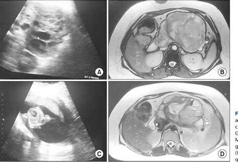 Figure 1 From Solid Pseudopapillary Epithelial Neoplasm Of Pancreas In Pregnancy A Case Report