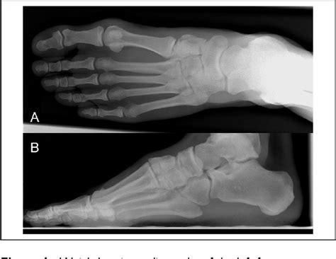 Figure 1 From The Bipartite Medial Cuneiform—a Rare Cause Of Midfoot