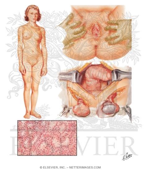 Disorders Of Sex Development