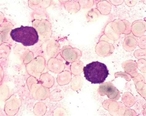 Bone Marrow Aspiration Revealed Morphological Findings Compatible With
