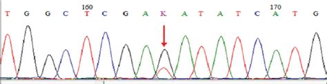 Acute Myeloid Leukemia With Nucleophosmin 1 Mutation Clonal Journal Of Precision Oncology