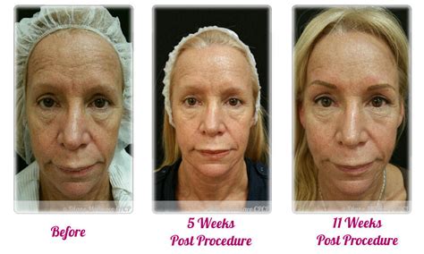 Micro Needling Diane Molinaro CPCP