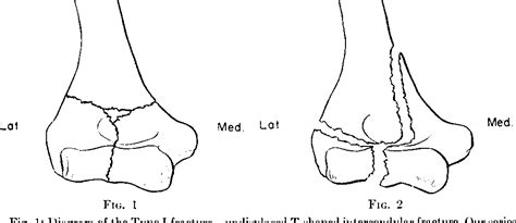 Figure 1 From Intercondylar T Fractures Of The Humerus In The Adult A