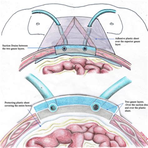 Abdominal Wall Closure A B Withdrawal Of Abthera System And Fascial