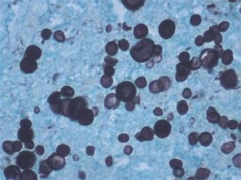 Cryptococcus Neoformans Gram Stain
