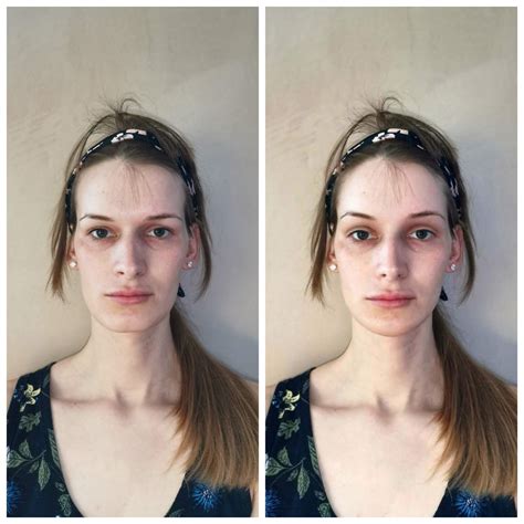 this is my before and after simulation with facial team i think it