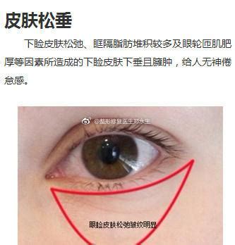 眼周抗衰下睑皮肤衰老的三种表现你是属于哪一种 知乎