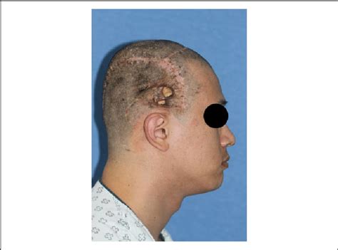 Preoperative Scalp Defect Download Scientific Diagram