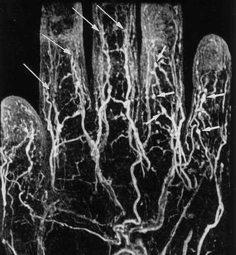 Buergers Angiogram Radiology Hand