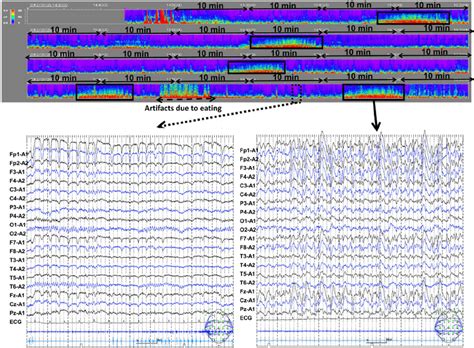 Color Density Spectral Array Cdsa For The Eeg Data Of Case 3 On The