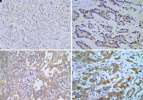Molecular Detection Of Fgfr2 Rearrangements In Resected Intrahepatic