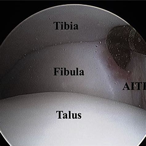 The Posterior Inferior Tibiofibular Ligament Pitfl Provides Most Of Download Scientific