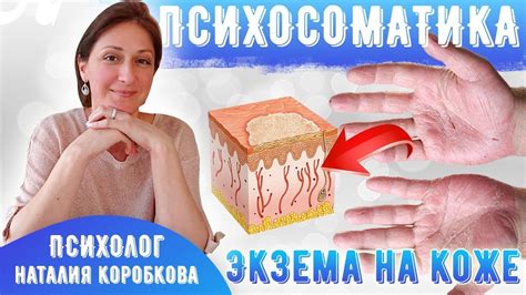 Нервная экзема симптомы причины возникновения лечение и профилактика