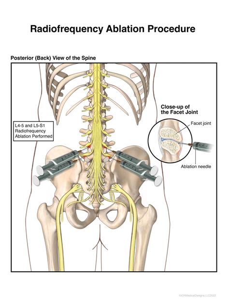 Radiofrequency Ablation Procedure