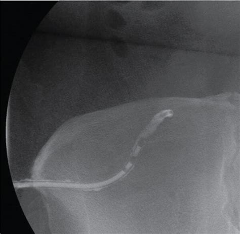 Case 4 Findings A Ct Showed Abscess Formation By Penetration Of Download Scientific Diagram