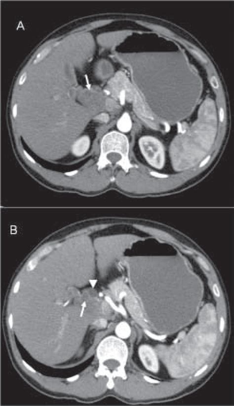 A B Axial Contrast Enhanced Ct Scans Show A Heterogeneous Download Scientific Diagram