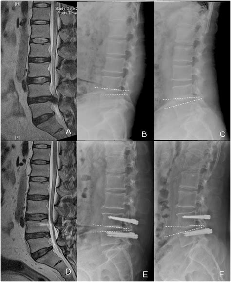 Spine X Ray Herniated Disc At Damian Goad Blog