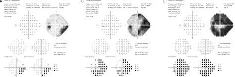 Glaucoma Visual Field