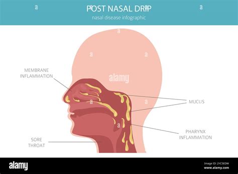 Post Nasal Drip Diagram Chronic Sinusitis Relief With North Oaks Ent