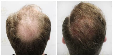 Dr Bonaros Glasgow Uk 4081 Fue Grafts 0 12 Months Hair Loss