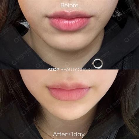 에이탑뷰티클리닉┃필러보톡스피부관리 Atop이 찾아드리는 세련된 V라인 ️ 뭉툭한 무턱의 턱라인을 매끄러운 V라인