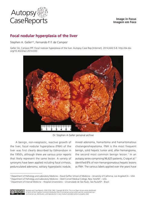 Focal Nodular Hyperplasia Gross