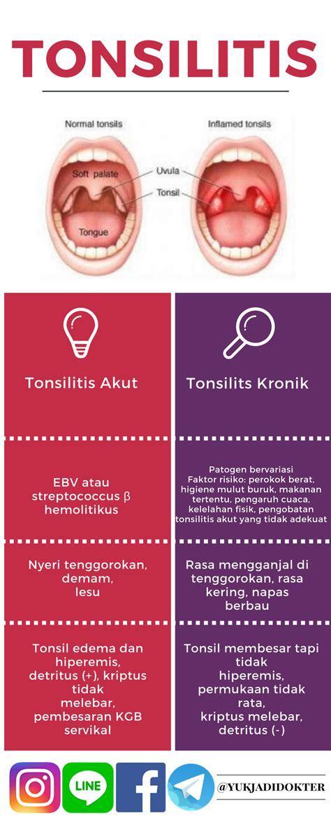 Tonsilitis Yukjadidokter