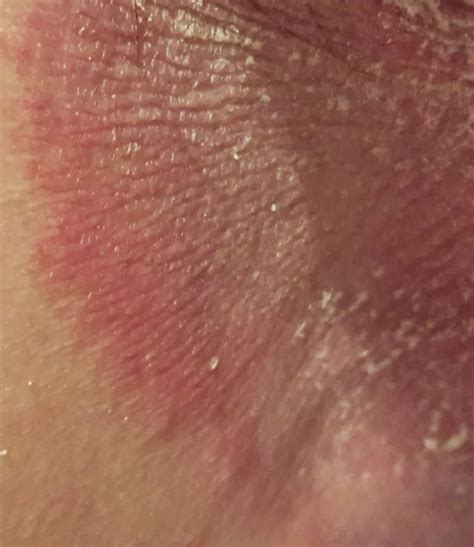 When To See A Doctor For Jock Itch Warning Signs To Watch Out For Itlbx