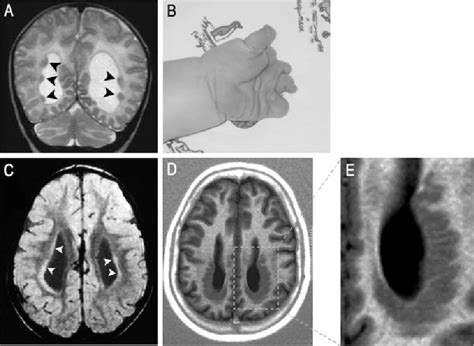 Periventricular Nodular Heterotopia Semantic Scholar