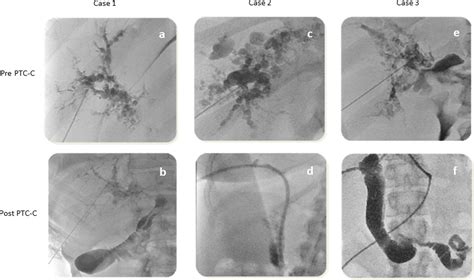 Percutaneous Transhepatic Cholangioplasty To Treat Multiple