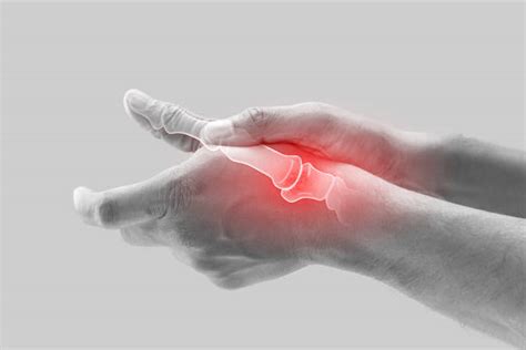 Reactive Arthritis Hands