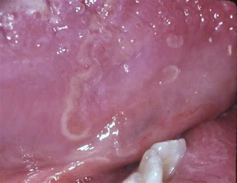 Chronic Hyperplastic Candidiasis