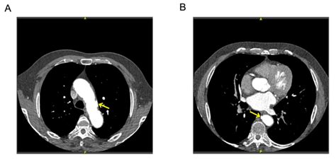 Ct Angiography Of The Aorta A Pau In The Aortic Arch B Pau In The Download Scientific