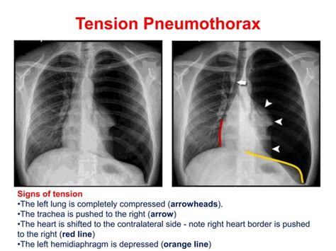 Pneumothorax In Chest Xray Interpretationpptx Pptx