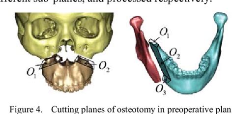 Figure 4 From Path Planning Of Robot Assisted Osteotomy In Orthognathic