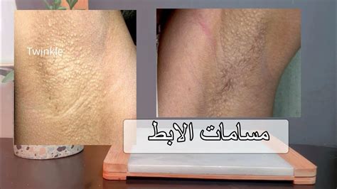 مسامات الابط او حبوب تحت الجلد في منطقة الابط Youtube