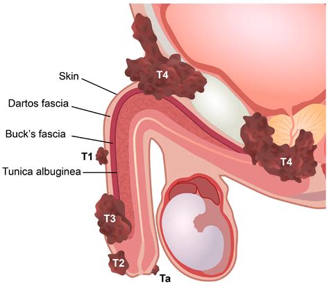 Multiparametric Magnetic Resonance Imaging Of Penile Cancer A