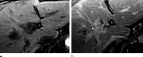 Intrahepatic Cholangiocarcinoma In A 69 Year Old Man A Axial