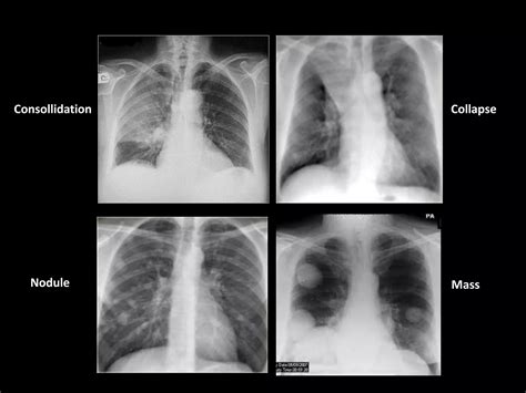 Chest X Ray Interpretation Pdf